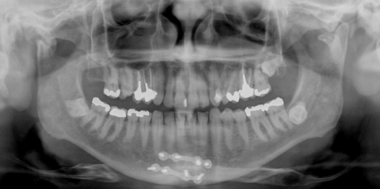 Condylar fractures - DDMFR