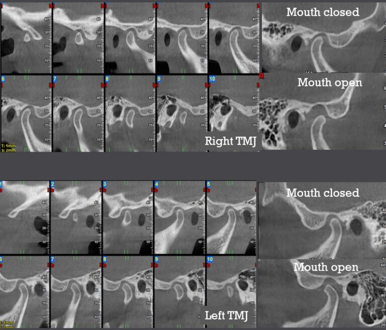 TMJ Internal derangement - DDMFR