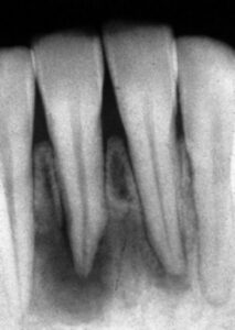 Periapical Cemento-Osseous Dysplasia 1st stage - DDMFR