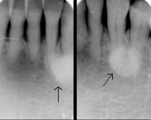 Tori and exostoses - DDMFR