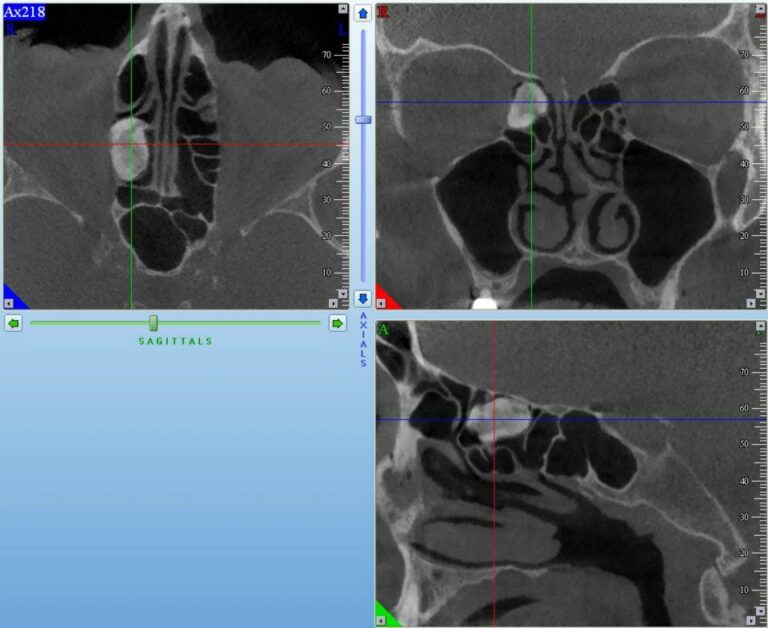 Osteoma of nasal cavity and paranasal sinuses - DDMFR
