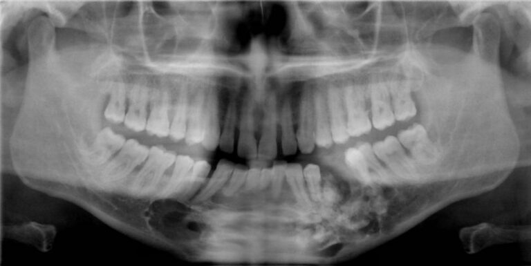 Calcifying epithelial odontogenic tumor (CEOT- Pindborg tumor) - DDMFR