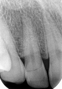 Fractures of the teeth - DDMFR