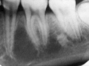 Simple bone cyst (traumatic cyst) - DDMFR